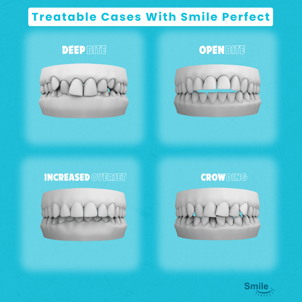 Affordable Clear Aligners | Invisible Braces | USA | Daytime Single ...
